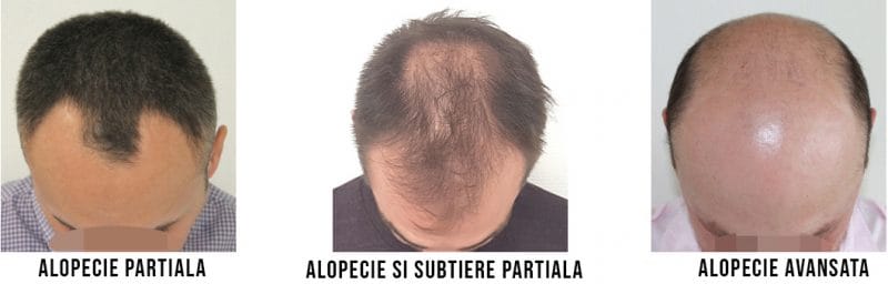 Alopecie Androgenetica | Ghidul perfect al pacientului