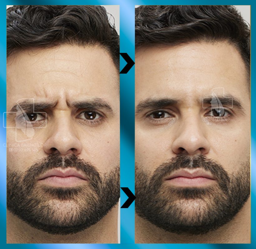 Rezultate estetica faciala | Clinica Barbatilor