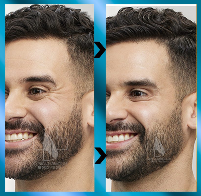 Rezultate estetica faciala | Clinica Barbatilor