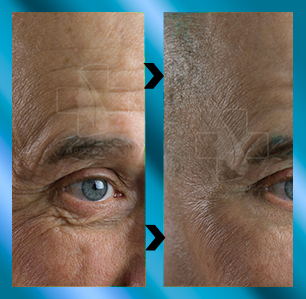 Rezultate estetica faciala | Clinica Barbatilor